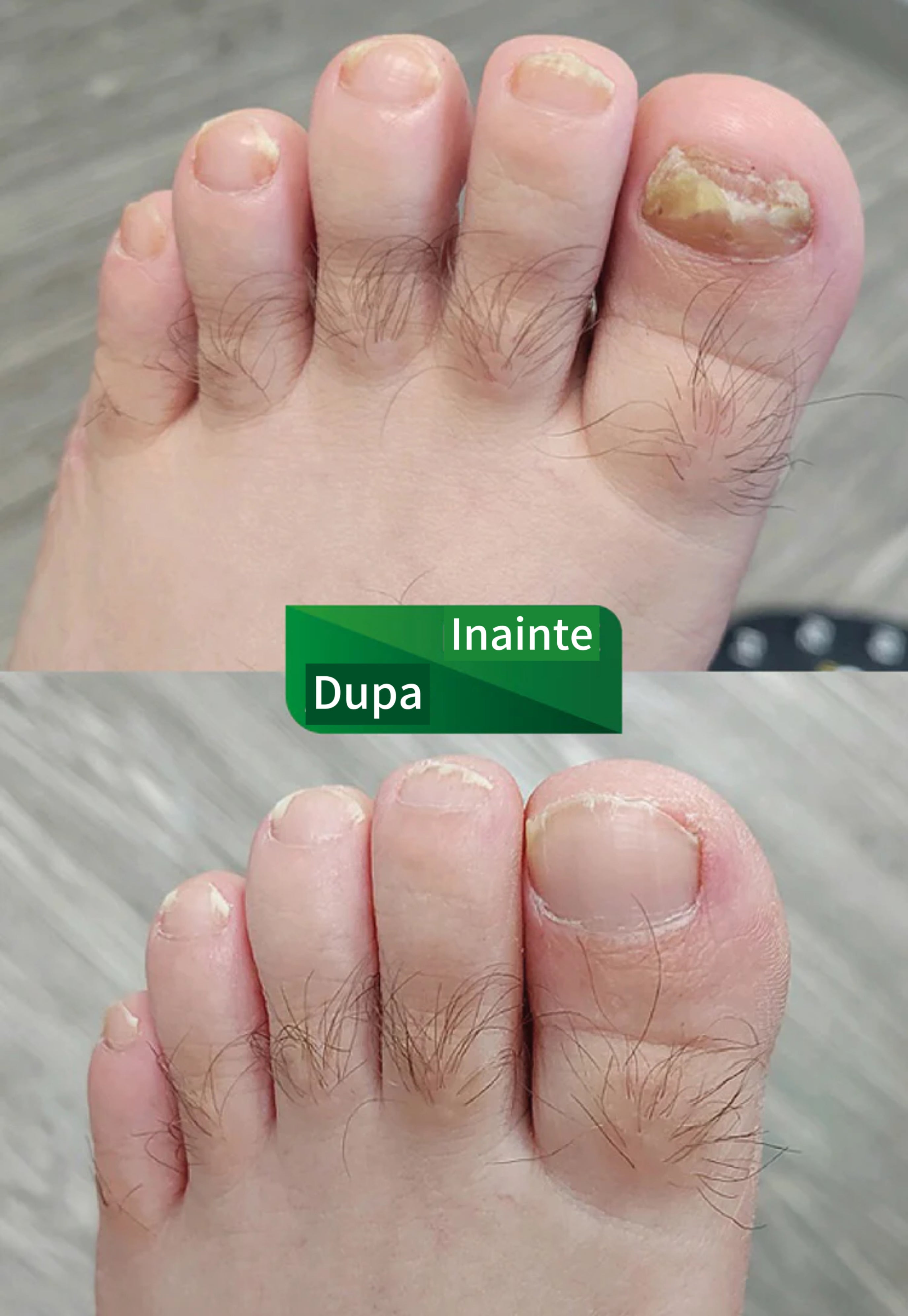 Ulei fungic pentru ciuperca – sined.ro